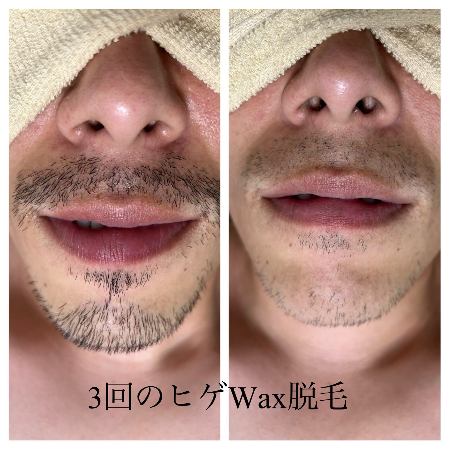 メンズ ヒゲall Wax脱毛